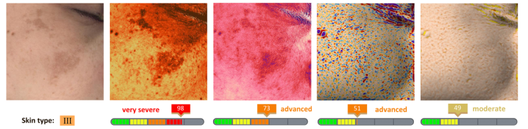 Aesthetic dermatology equipment, 3D camera & software for skin analysis